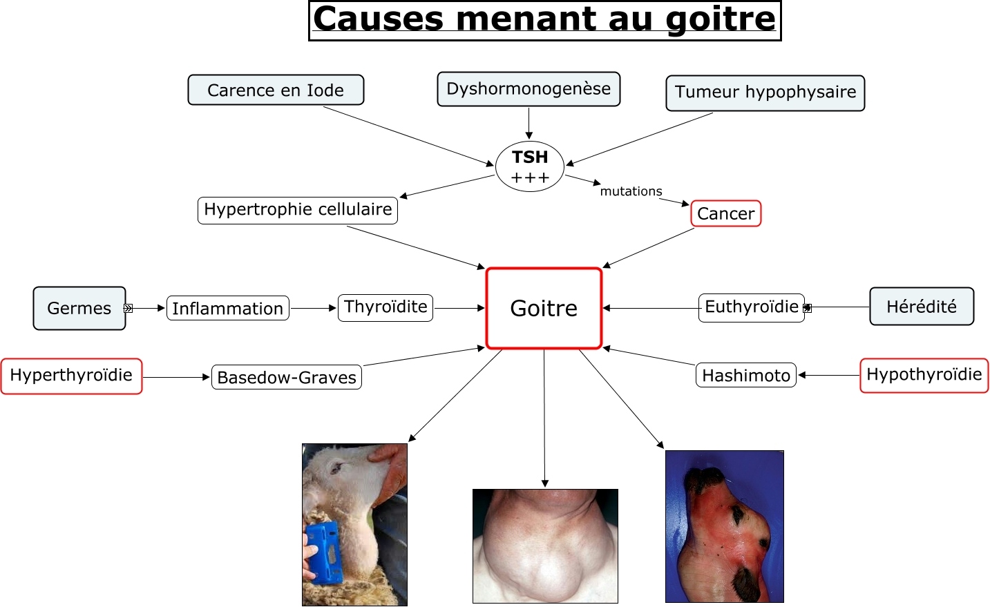 Goitre